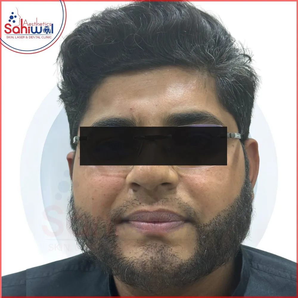 Best Beard Hair Transplant Clinic In Sahiwal Burewala Pakistan